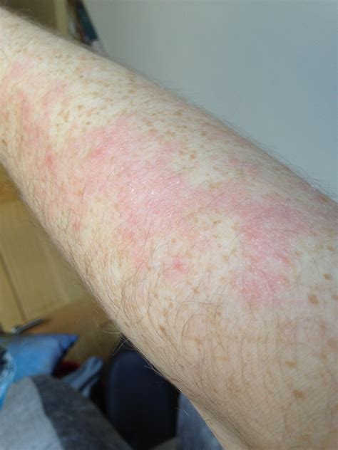 Psoriasis Blog Archives Toby Hadoke Comedian Actor Writer Quite Likes Doctor Who