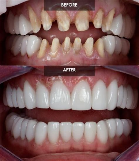 Zirconia Crowns Before And After
