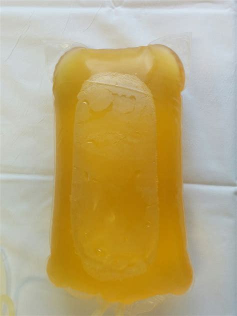 Pd Fluid Fibrin In Peritoneal Dialysis Fluid How Peritoneal Dialysis