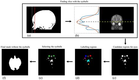 The Proposed Eye Removal Algorithm A In The Sagittal Slice With The