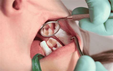 What Is A Dental Operculum