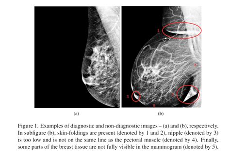 Automatic Quality Assessment In Mammography Screening A Deep Learning Based Segmentation Method