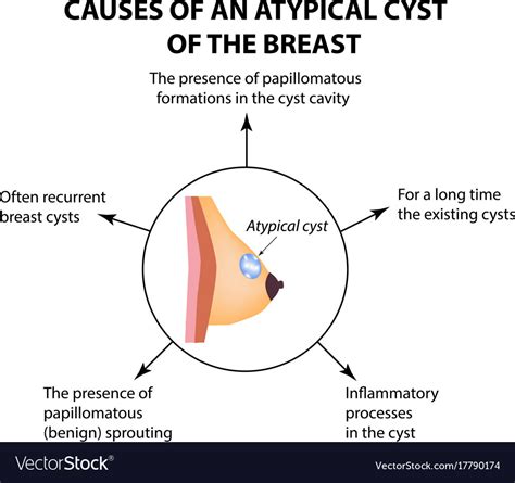 Causes Atypical Cyst World Breast Cancer Day Vector Image