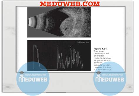 Normal And Abnormal B Scan Meduweb