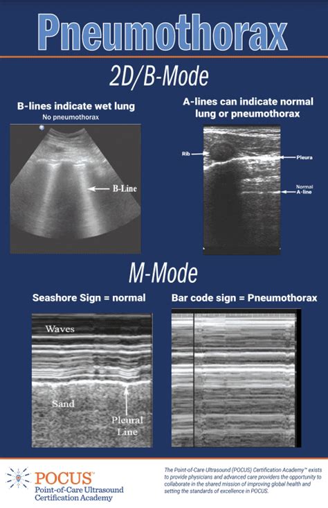 Pneumothorax Pocus Resources And Case Studies