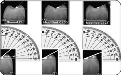 Normal And Modified Buccal Cusp Inclinations Download Scientific Diagram