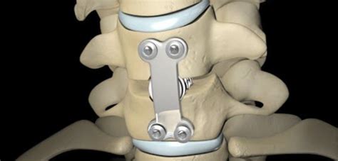 Anterior Cervical Discectomy And Fusion Acdf Smit Medimed Pvt Ltd