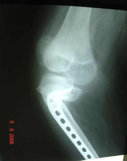 Lateral View With Marked Procurvatum Deformity Download Scientific