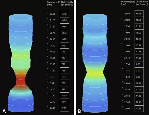 Endoflip Topography Of Case 1 At A Volume Of 60 Ml A Pre Poem Download Scientific Diagram