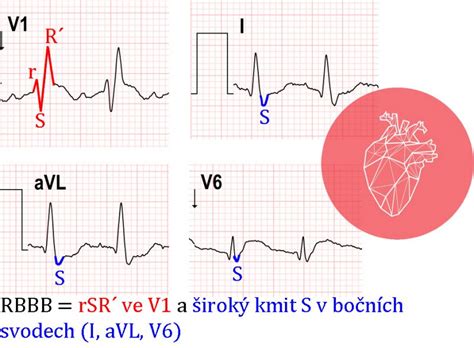 MegaSTEMI Kardioblog