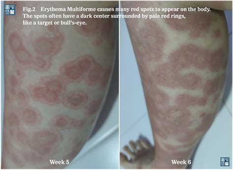 Erythema Multiforme Or Urticaria Vasculitis Different Paths Lead To