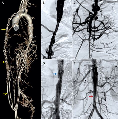 Takayasu Arteritis Jacc Focus Seminar 34 Jacc