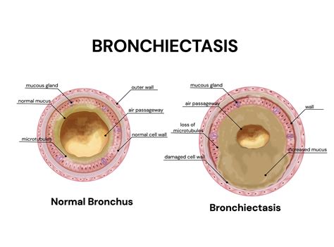 Bronchiectasis Exacerbations In Patients With And Without Asthma