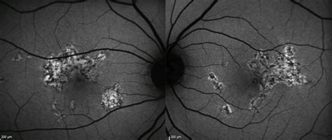 Acute Posterior Multifocal Placoid Pigment Epitheliopathy Apmppe