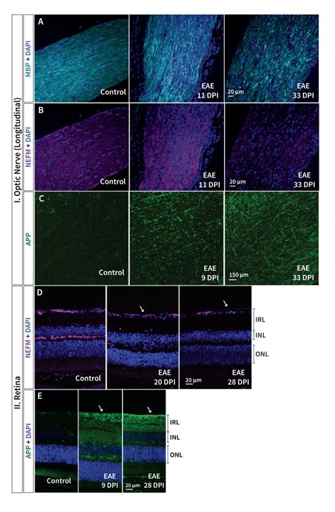 Demyelination And Axonal Pathology Was Perceived In Both The Retina And