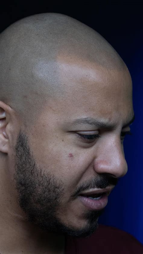 High Definition Unedited Before 1 Year Healed And Immediately After A