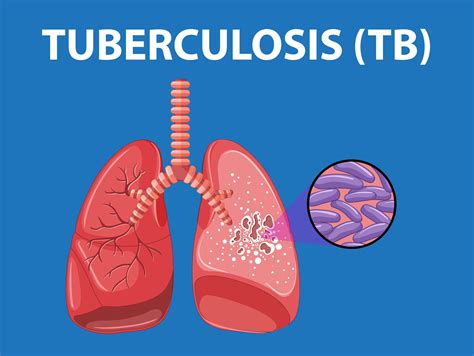 Tuberculosis Causes Prevention And Management The Health Thread Infectious Diseases And