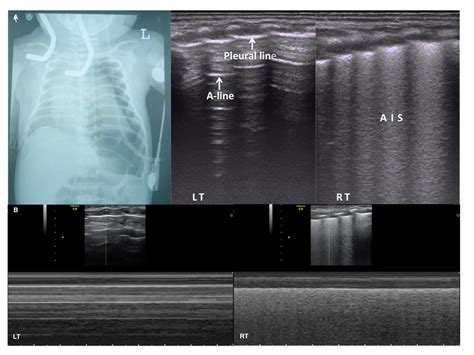 Protocol And Guidelines For Point Of Care Lung Ultrasound In Diagnosing