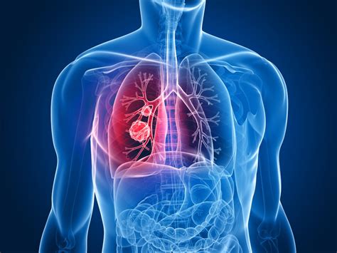 Stages Of Lung Cancer Dr Peter Mikhail