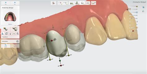 디지털 크라운 미소안치과