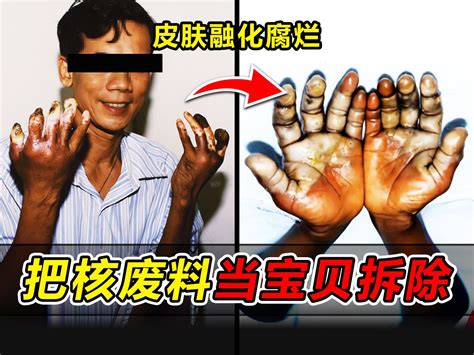 男子偷走核废料以为是宝贝！拆除后皮肤融化腐烂，爆发千人核事故 蓝星人 Et 蓝星人 Et 哔哩哔哩视频