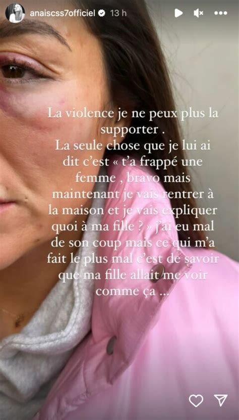 Anaïs Camizuli défigurée la candidate des Cinquante victime d une