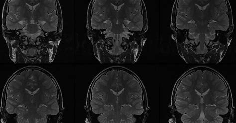 Dr Balaji Anvekar Frcr Bilateral Mesial Temporal Sclerosis Mri