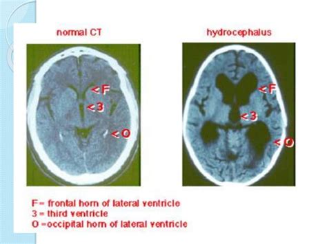 Normal Brain Ct Scan Vs Hydrocephalus Explained Ppt