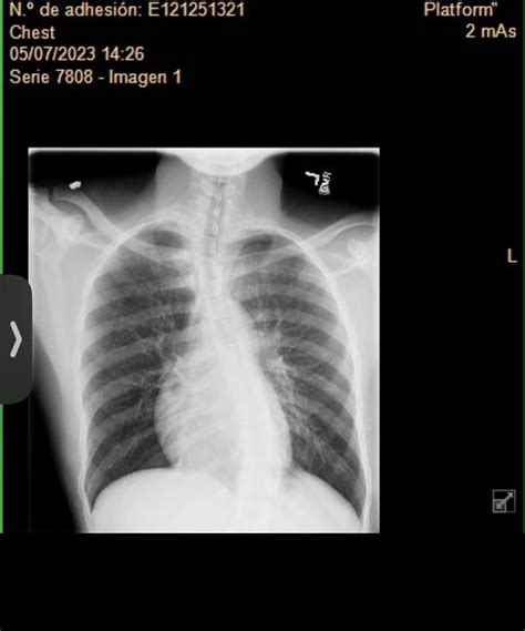 Took A Chest Xray Because I Got Into A Motorcycle Crash And I Found