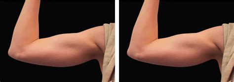 Results Central Wellness Medical And Aesthetic Billings Mt