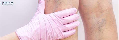 Endovascular Surgery For Varicose Veins Cheng Sc Veins And