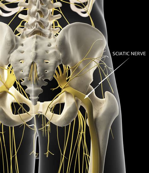 Sciatica Charlotte Chiropractic Center Pllc