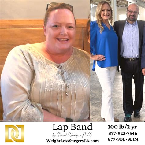 Lap Band Surgery Bmi At Chloe Dunbar Blog
