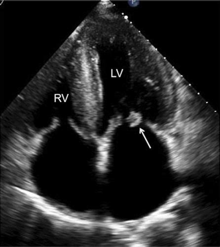 Flail Mitral Valve Leaflet