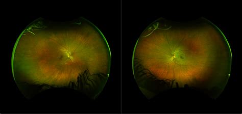 Non Proliferative Diabetic Retinopathy Case Study