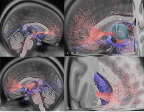 Defining A Tract Based Target For Obsessive Compulsive Disorder Network Stimulation Laboratory