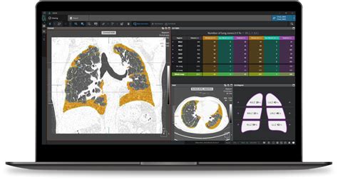 Aview Ila Ai For Interstitial Lung Abnormalities