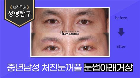 [눈성형 수술전후] 중년남성 처진눈꺼풀 눈썹아래거상 Youtube