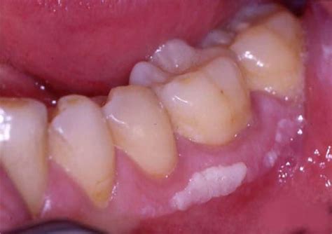 Cancer White Spots On Gums Treatment Cancer White Spots On Gums Treatment