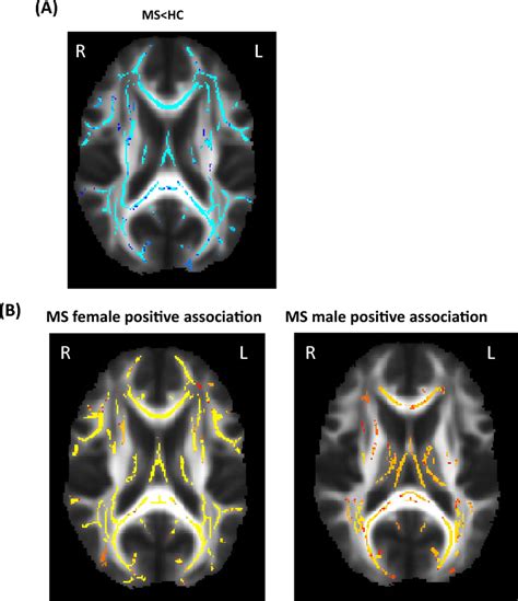 A Group Wise Differences In Regional WM FA And Correlations Between
