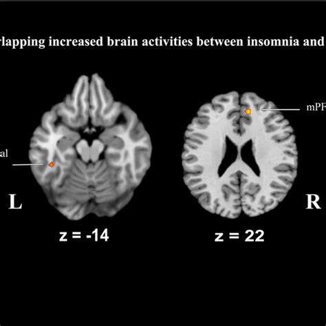 Pattern Of Overlapping Increased Activities Between Insomnia And Scz
