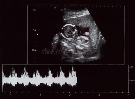 De Ultrasone Klank Van Het Foetus Stock Foto Image Of Menselijk