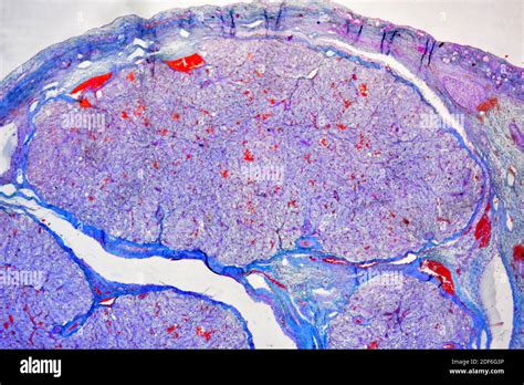 Human Ovary Section Showing Corpus Luteum And Epithelium Optical