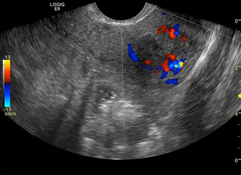 Uterine Fibroids Ultrasound Findings