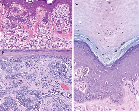 New And Evolving Concepts Of Melanocytic Nevi And Melanocytomas