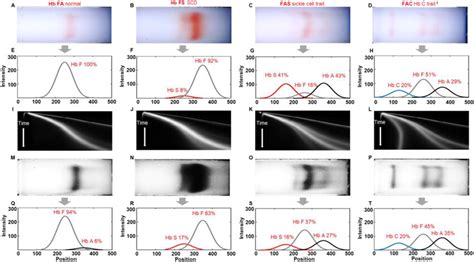 Identification Of Hb Variants And Quantification Of Hb Percentages By