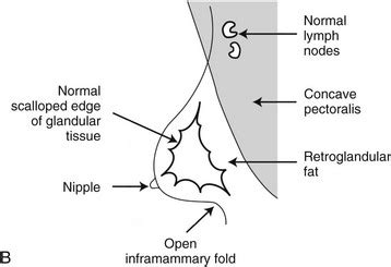 Mammogram Interpretation Radiology Key