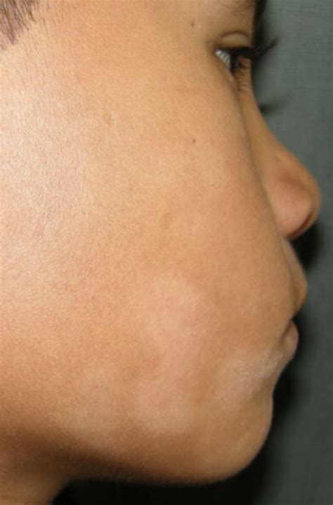 Cara Manchas Blancas En La Piel Por Estrés Porestré