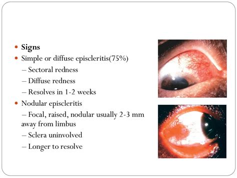1168 Episcleritis And Scleritis Pdf Fir Jrs Pdf