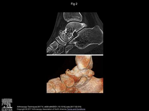 Arthroscopic Excision Of Osteoid Osteoma Of The Talus Ppt Download
